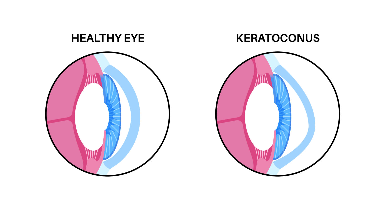 Help Prevent Vision Loss with Corneal Cross-Linking - WashU Medicine ...